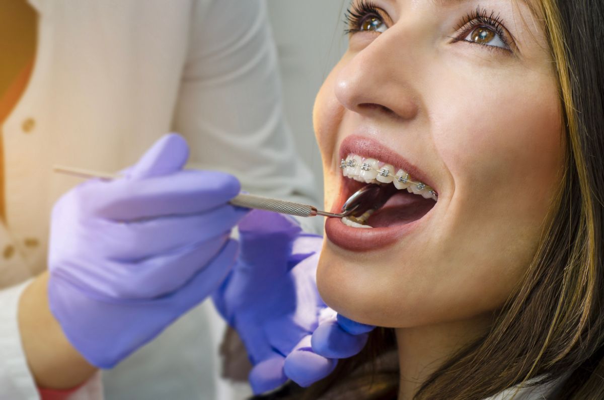 Debunking Common Myths About Braces For Adults | Sawgrass Orthodontics