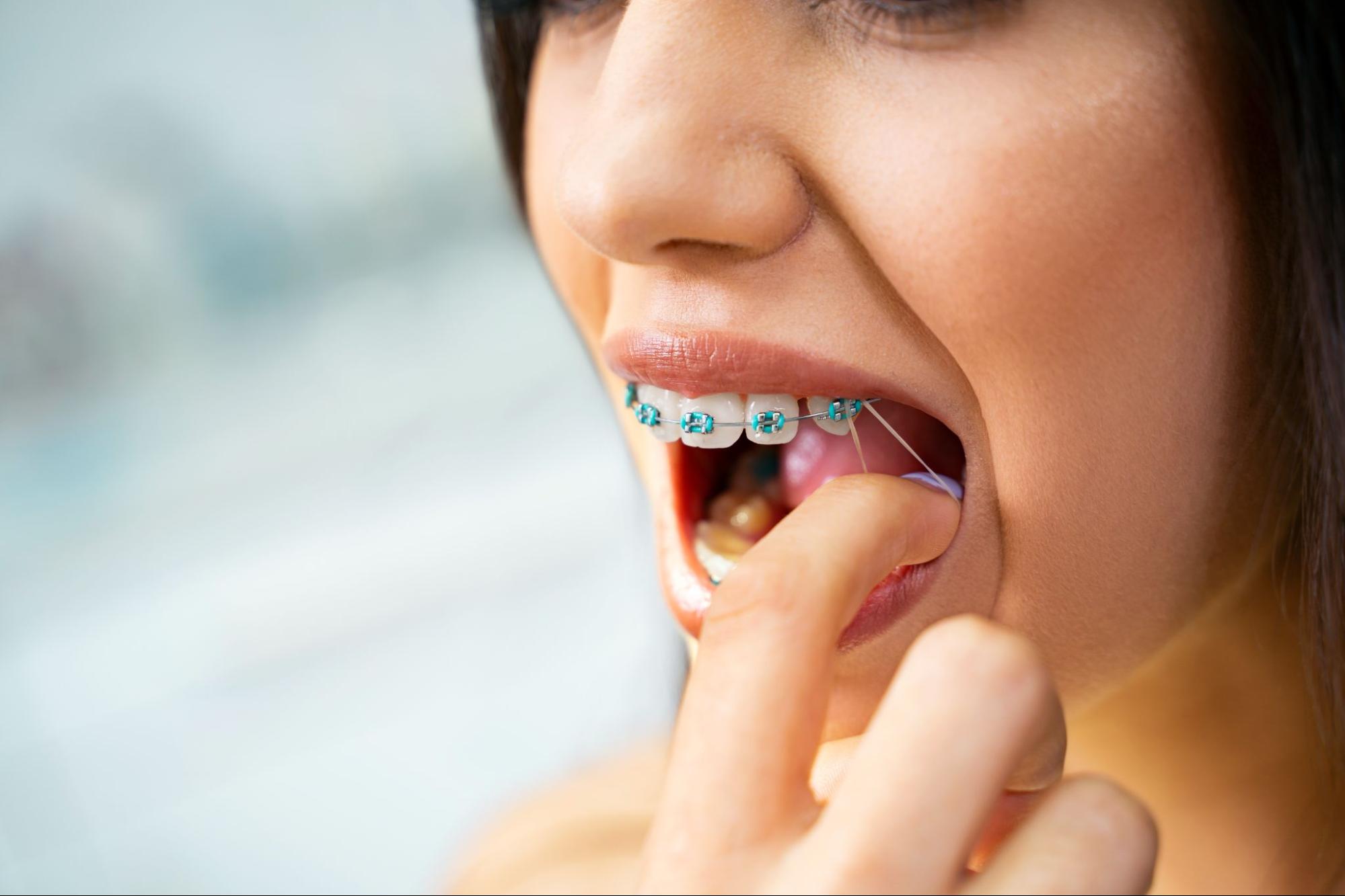 What Role Do Bands and Elastics Play in Orthodontic Treatment?